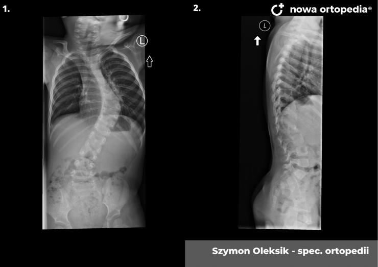 Skoliozy wczesnodziecięce - Szpital Dworska
